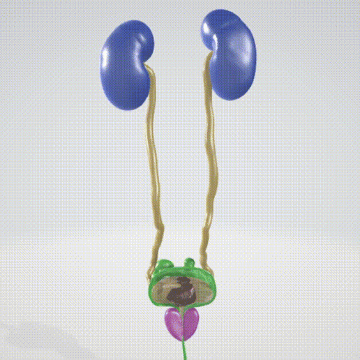 ♂️ 6 PARTS 3D Benign prostatic hyperplasia with complications ...