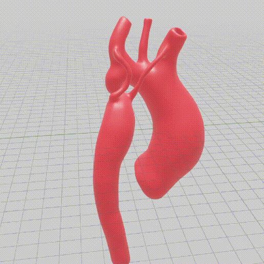 Archivo STL 3D congenital heart disease: Aortic Stenosis 💜 (OBJ)・Idea ...