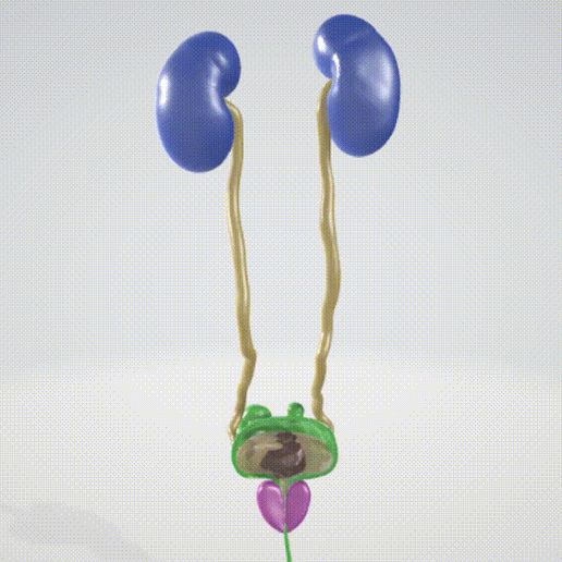 Archivo STL 3D Benign prostatic hyperplasia with complications ...